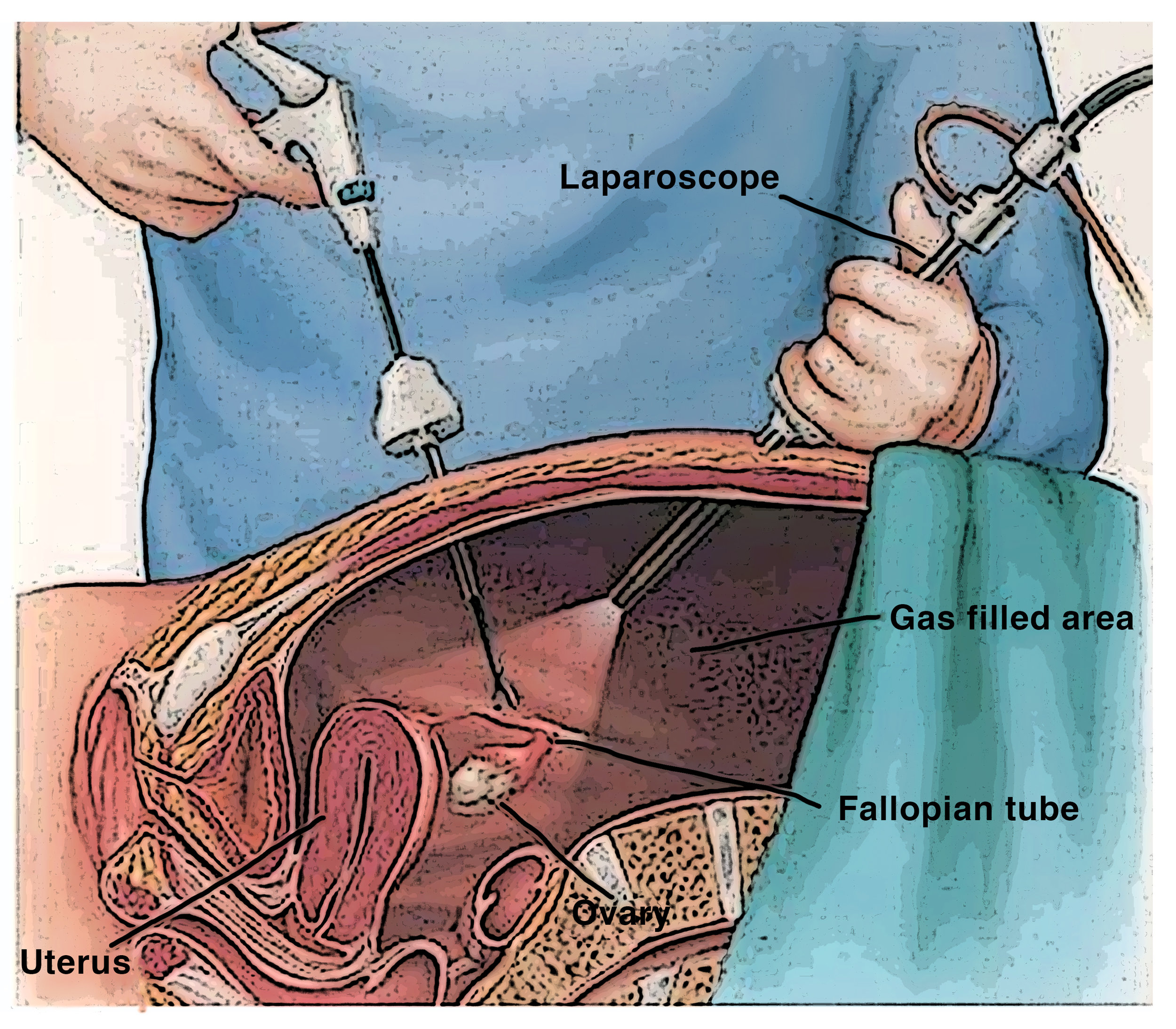 principles of laparoscopic surgery – جمعية الجراحين الأردنيين